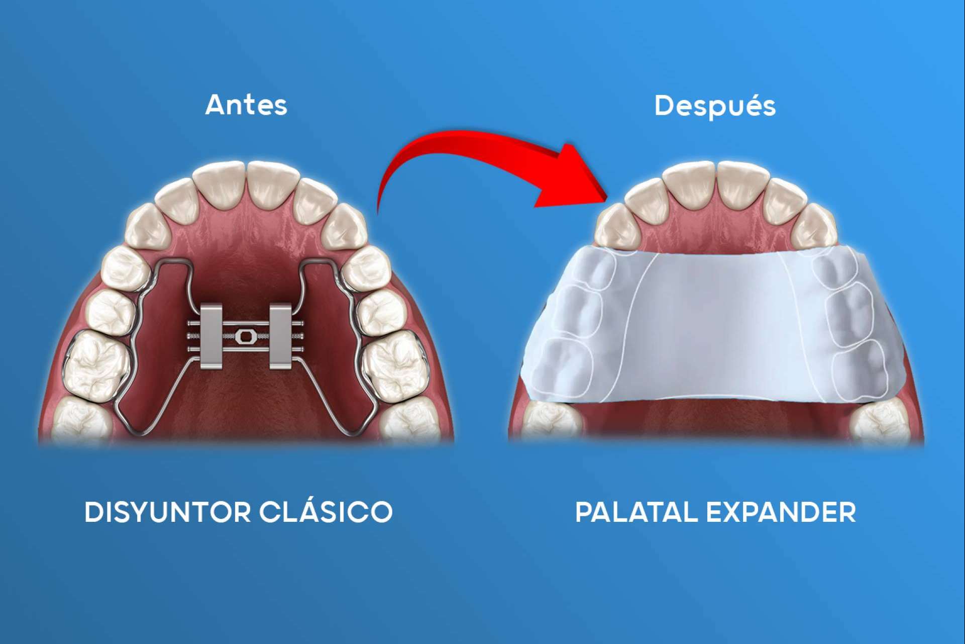 Doctores murcianos lideran la revolución en ortodoncia con expansores ...